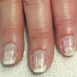 How to deal with damaged nails - Scratch Magazine